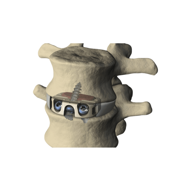 Cages Stalif lombaires et cervicales - Société Spinaxis