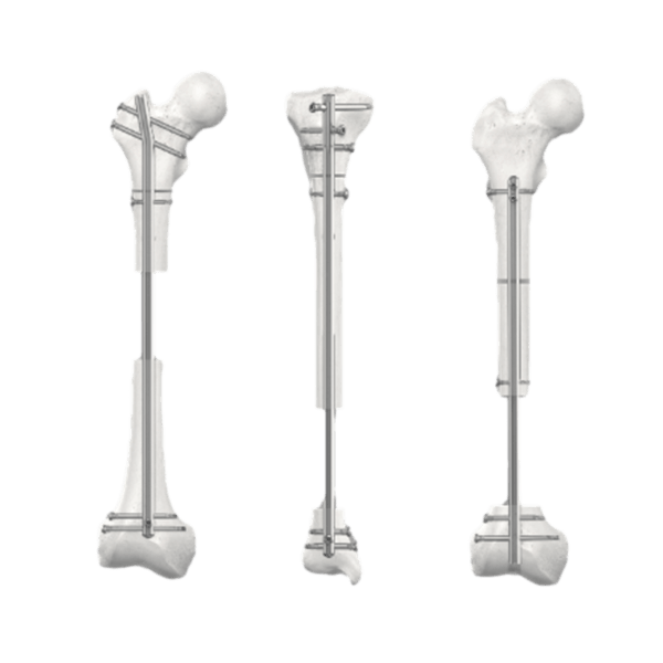 Precice® Bone Transport - Défects osseux - Spinaxis