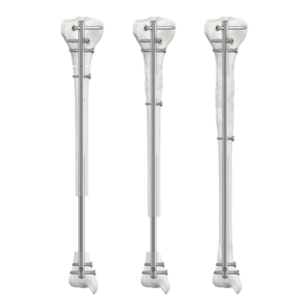 Precice® Bone Transport - Défects osseux - Spinaxis