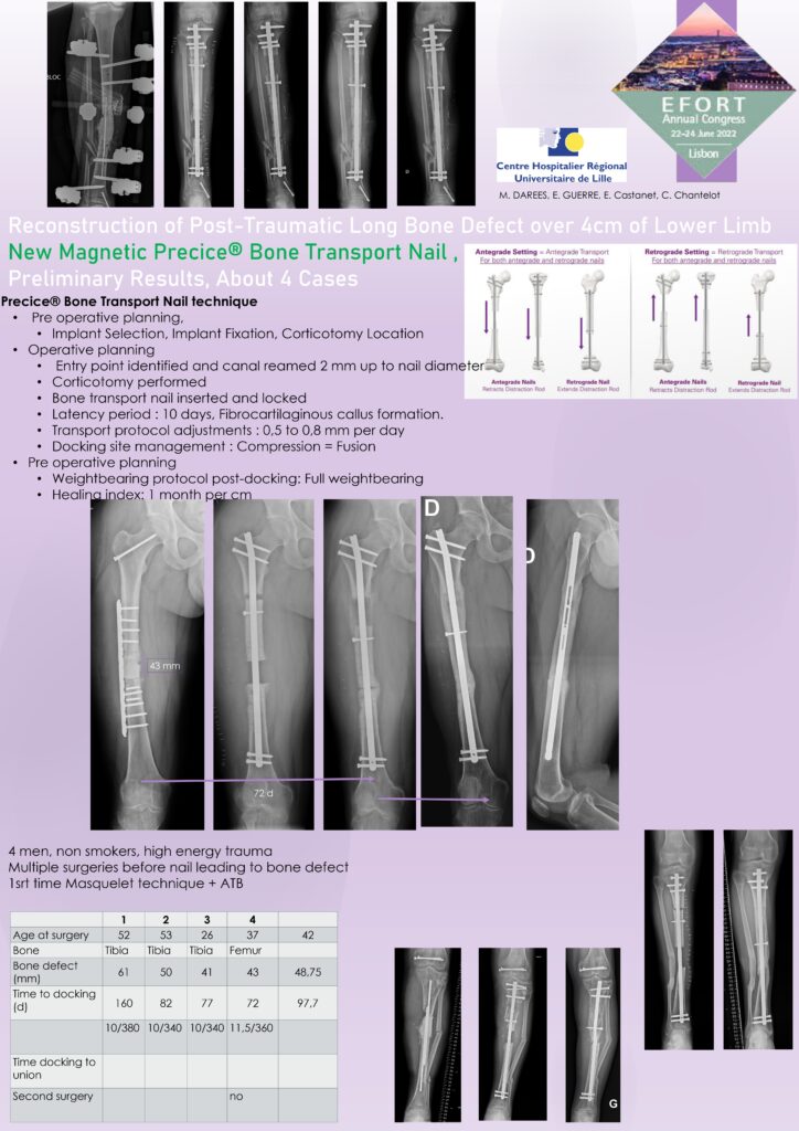 New Magnetic Precice® Bone Transport Nail - Spinaxis